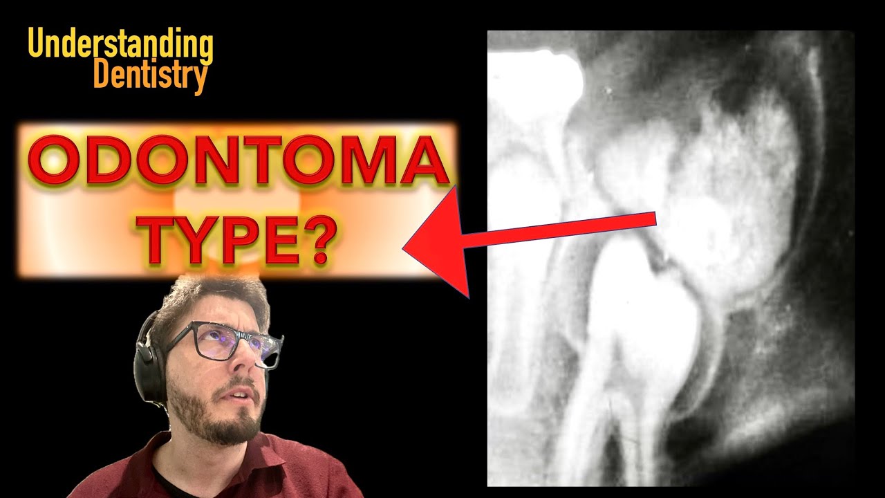 ALL about ODONTOMA & Differences between Compound and Complex Odontoma!! 