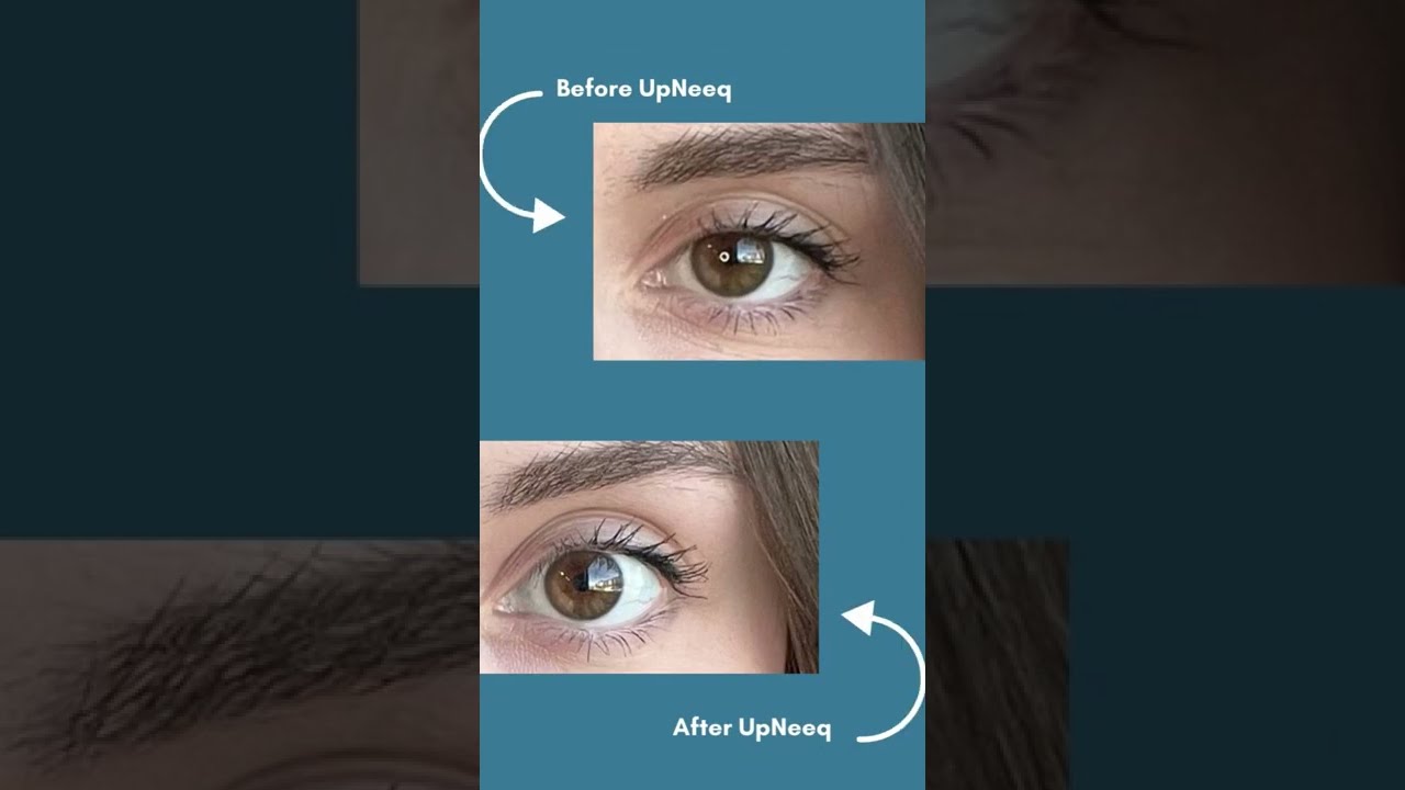 Introducing UpNeeq Eyedrops for Low-Lying Eyelids (Ptosis)