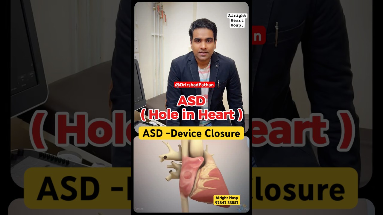 Atrial Septal Defect | ASD device Closure | Dr Irshad Pathan | most common Hole in heart ❤️ #asd