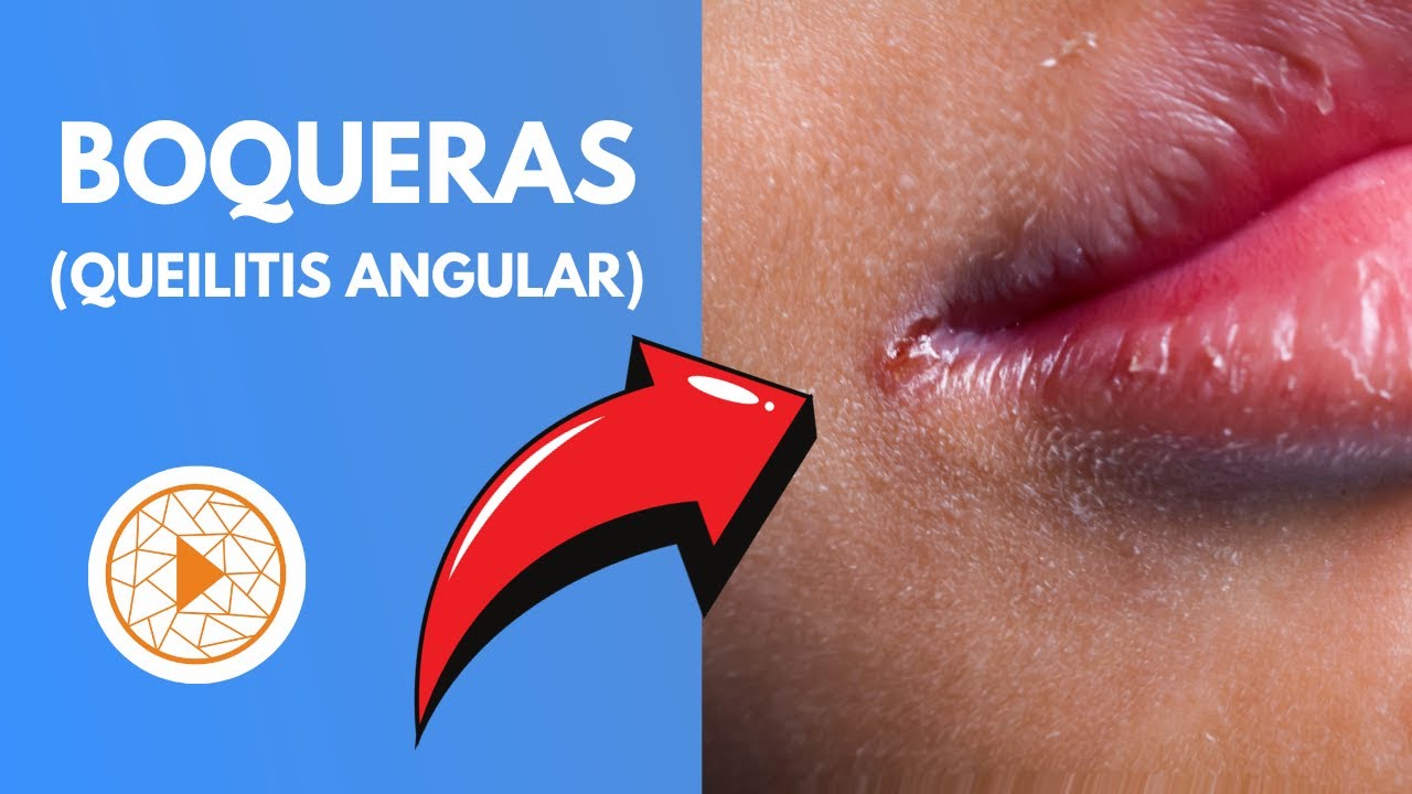 Angular cheilitis (or angular cheilitis) | How to cure it quickly and understand its causes