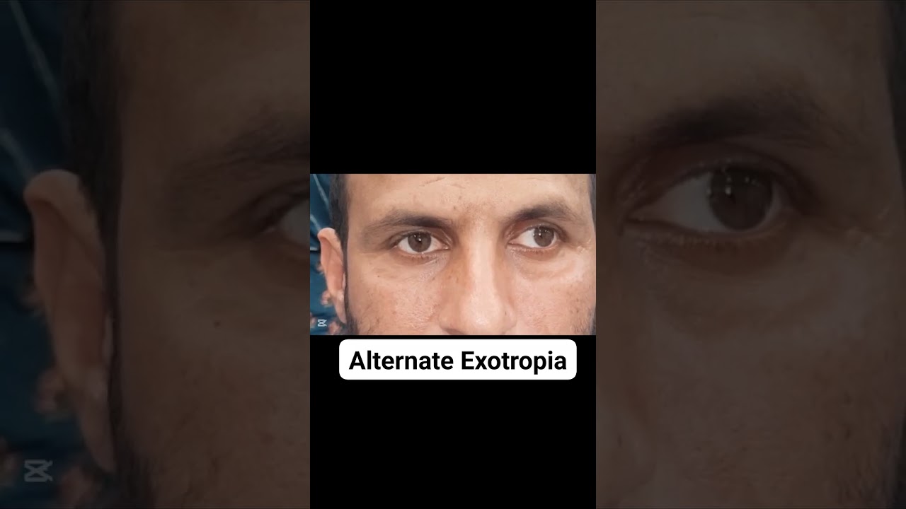Alternate Exotropia/Short cases #doctor #eyedisease #squint#optometry #eyesurgery