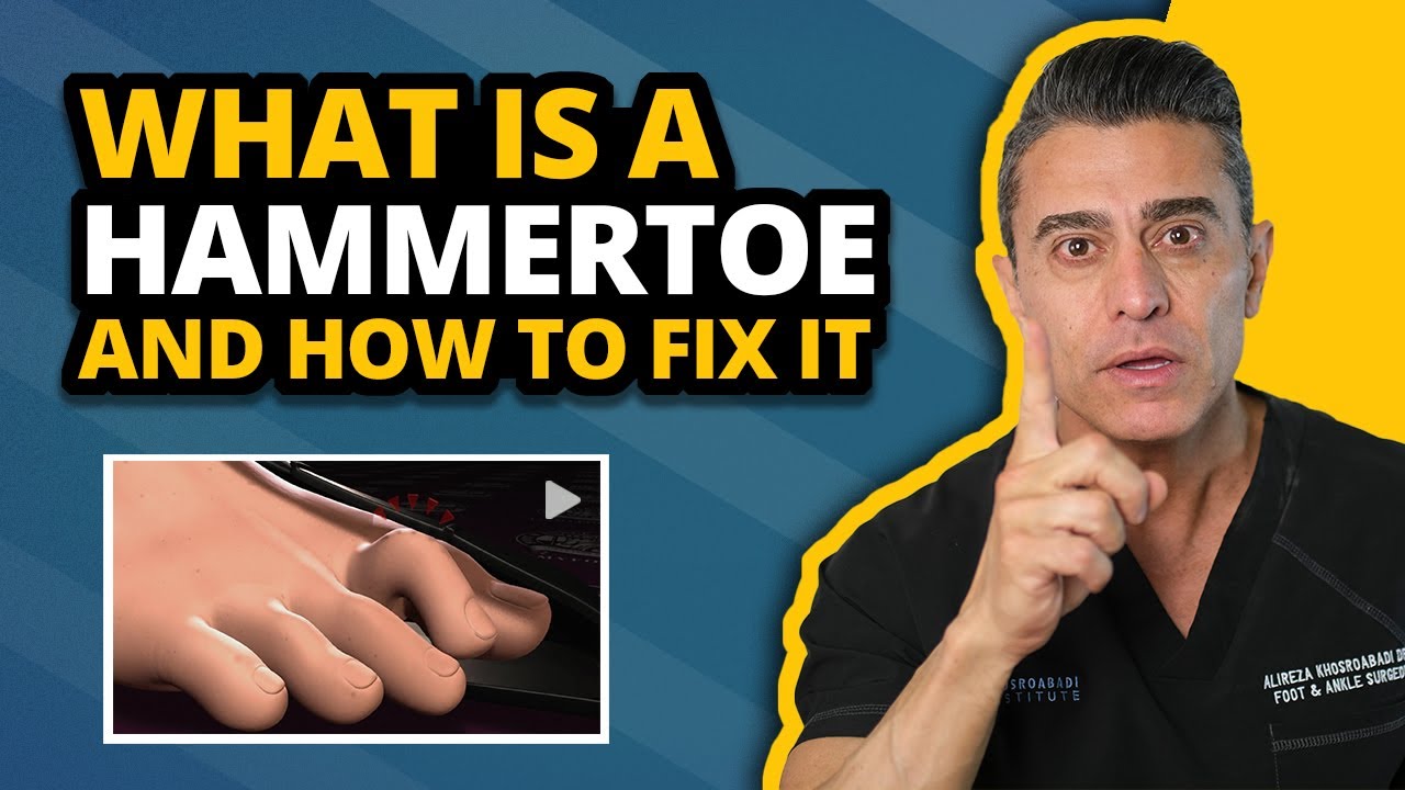 Everything You Need To Know About Hammertoes