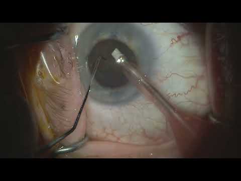 20250520 162141 ASX1, Phaco, very small pupil