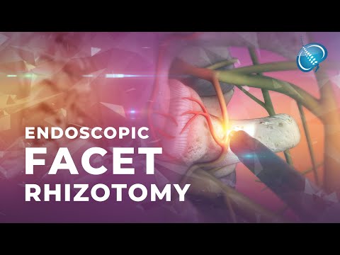 What is Endoscopic Facet Rhizotomy?