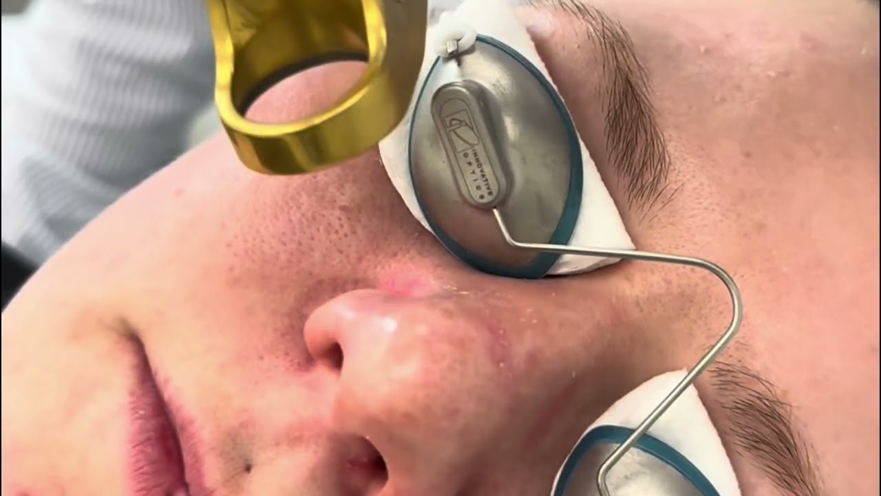 Danielle’s Rosacea Journey: How Laser Genesis Transformed Her Skin!