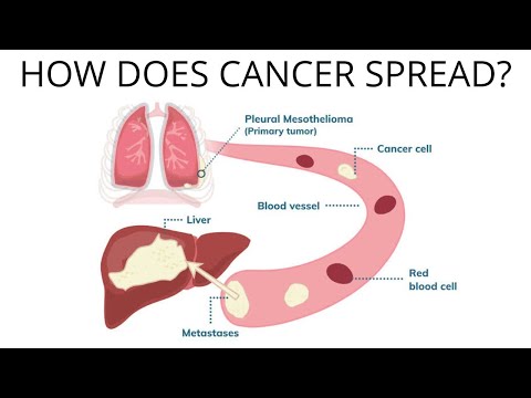 केंसर कैसे फैलता है? How does cancer spread? #petct #fdg #petctscan #metastasis #lungcancer #petscan