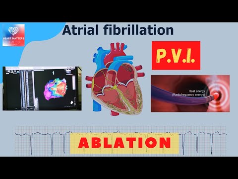 Atrial Fibrillation Ablation Procedure | Pulmonary Vein Isolation