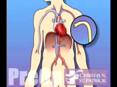 PreOp Stent Implantation Coronary Angiopl