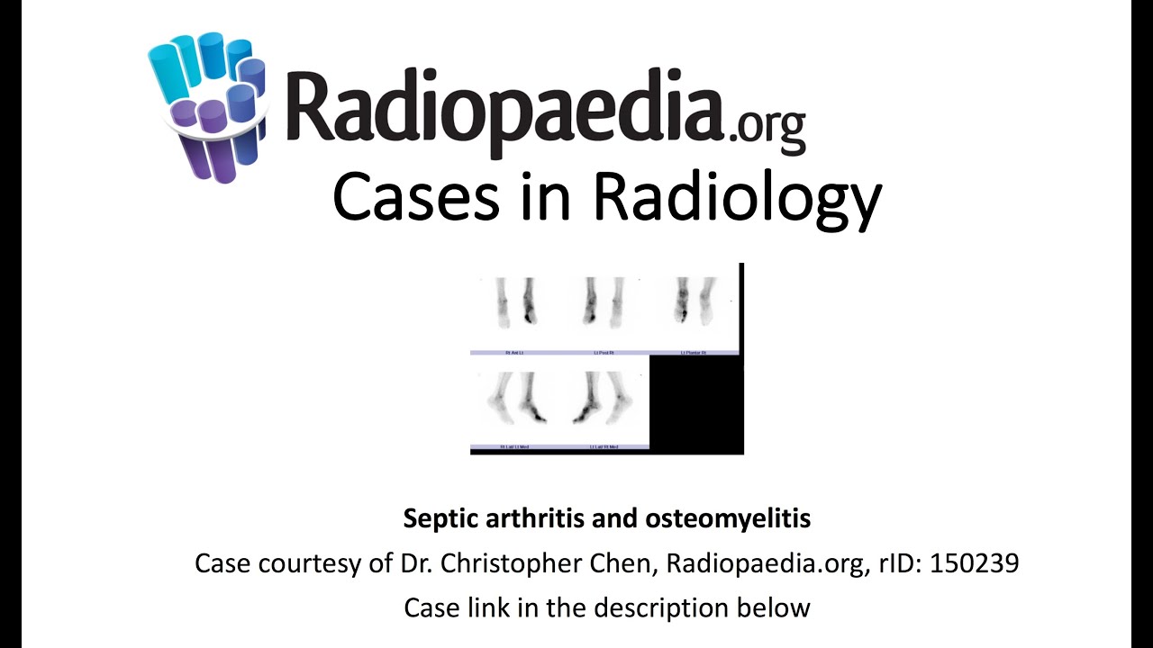 Septic arthritis and osteomyelitis (Radiopaedia.org) Cases in Radiology