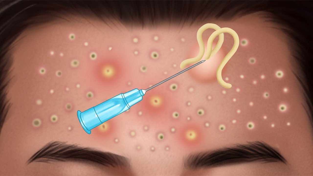 [ASMR] Big Blackhead Removal Animation | 잘익은 여드름,블랙헤드 한번에 짜기 / Acne Huong da nang