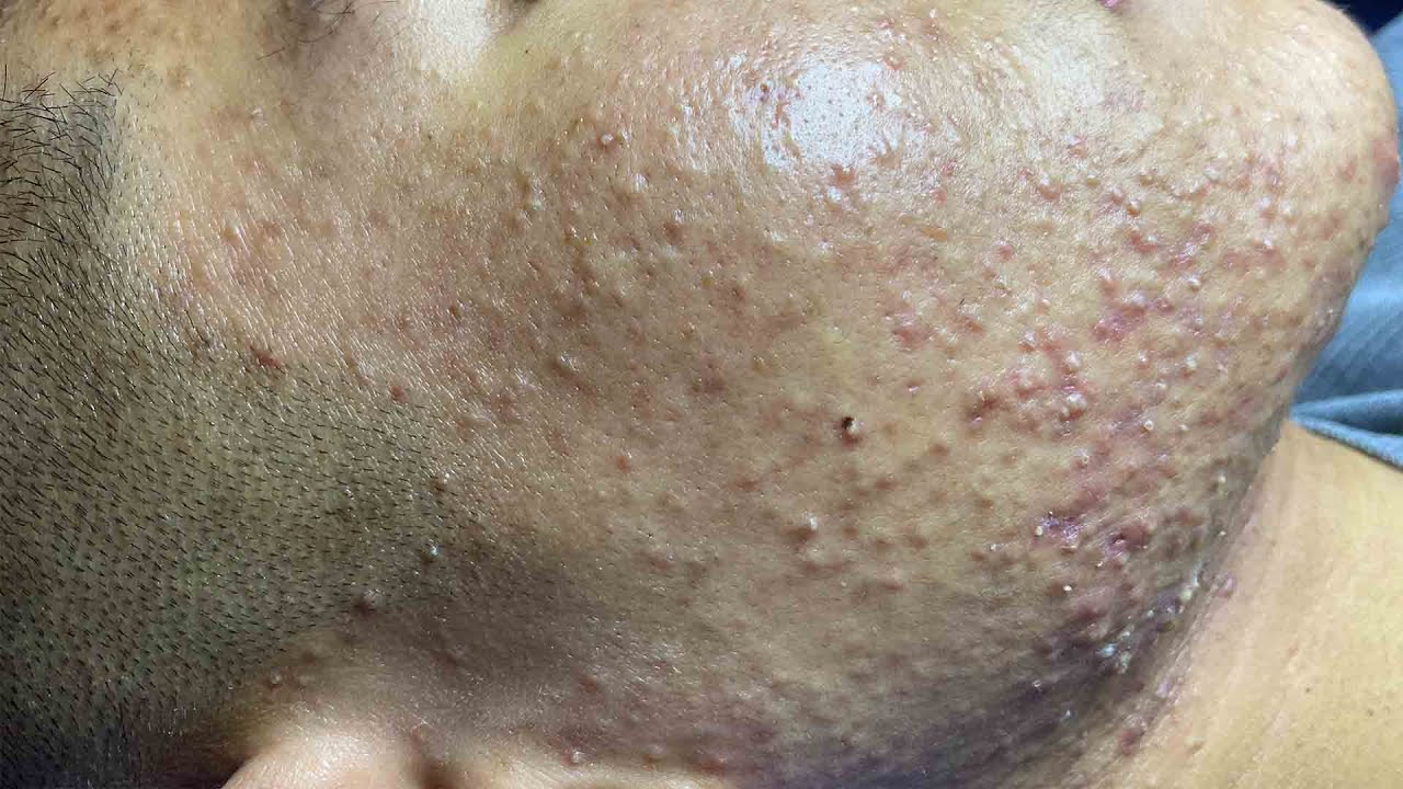 Acne Treatment For 