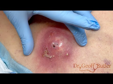 Top Dermatologist Reveals BEST Cyst Removal Techniques