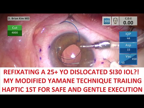 Refixate a 25+ Year Old Dislocated SI30 IOL?! My Trailing Haptic 1st Technique is Easier to Execute