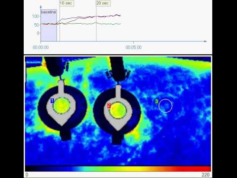 Iontophoresis of acetylcholine and sodium nitroprusside on forearm