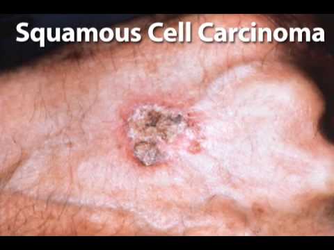 Understanding Squamous Cell Carcinoma (Health Short)