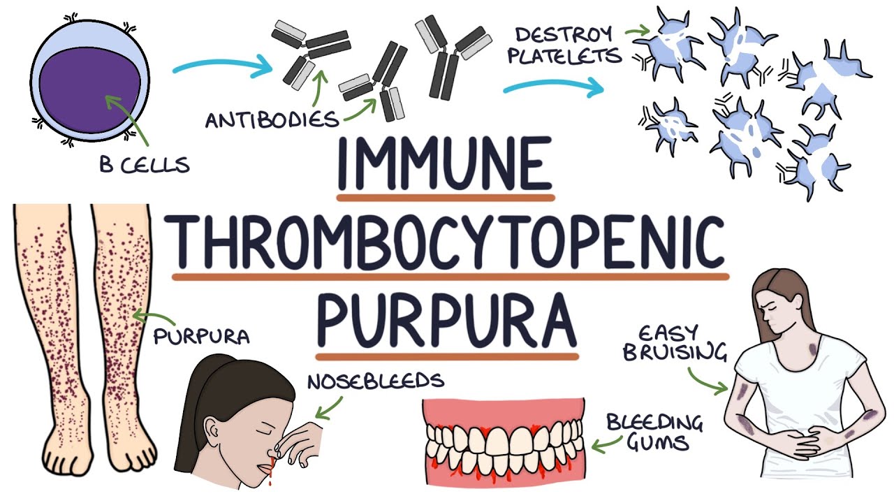 Understanding Immune Thrombocytopenic Purpura - ITP
