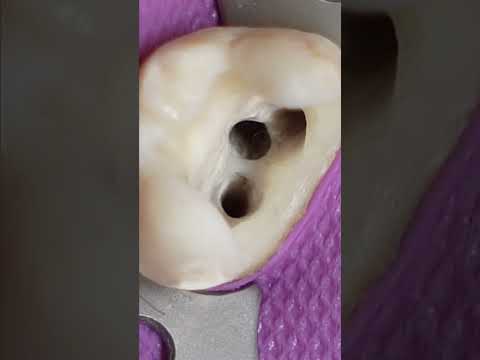Root Canal Procedure All Steps In 4K |#Tooth Restoration |#shorts