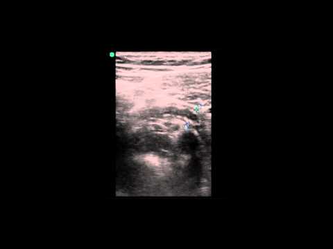 Short Appendicitis Video