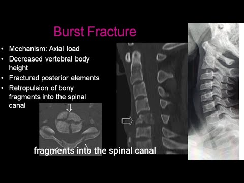 cervical spine -trauma Radiology @RadiologyChannel @educationalradiologychanne9079