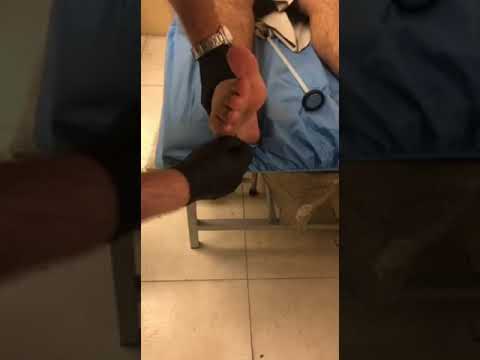Findings ; spasticity , Babniski and hyperreflexia