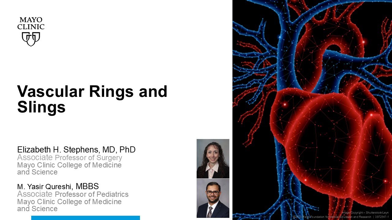 WEBINAR: Vascular Rings and Slings