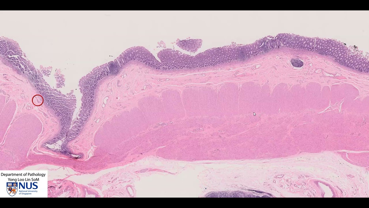 Colon: Hirschsprung disease Microscopy - Talking slide
