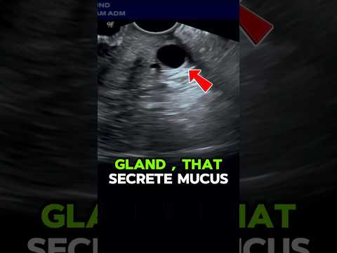 Nabothian Cyst in CERVIX #ultrasound #uterus #cervical #mass #cyst