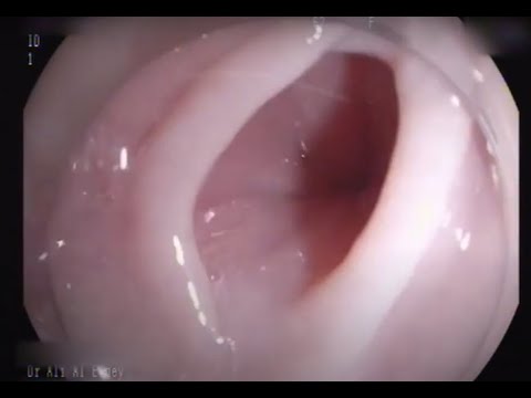 Dilatation of Esophageal Ring