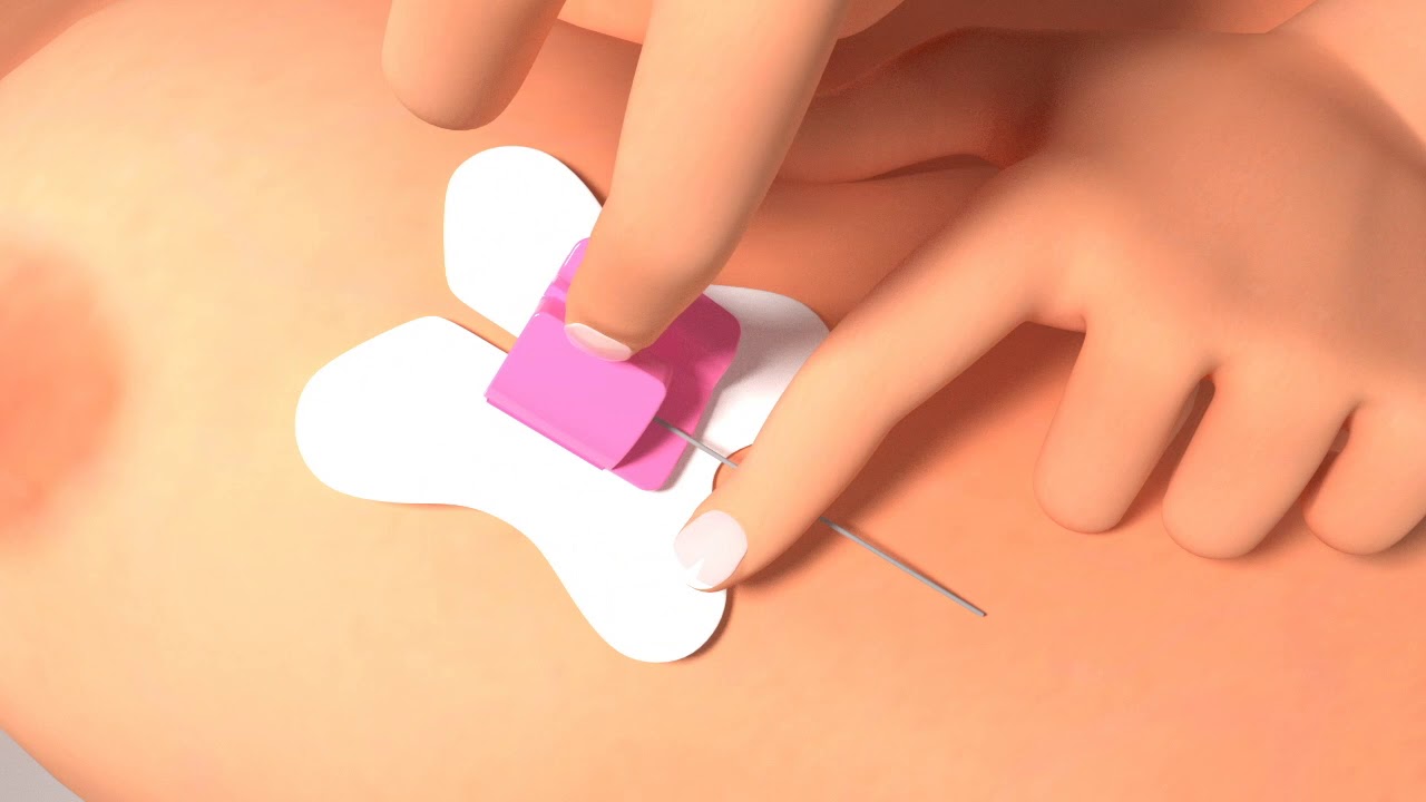 WireFix instructions for use