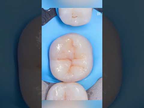 Composite tooth filling: What is it, how does it work and why is it becoming more popular?