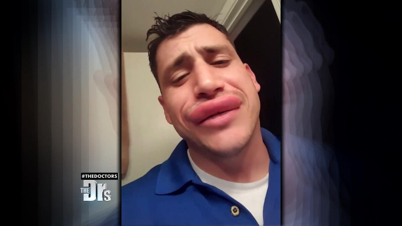 Wasp-Stung Lips?