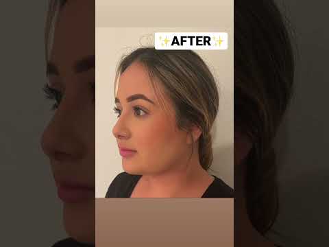 Buccal fat removal and chin liposuction combo procedure! AMAZING #beforeandafter #weightloss