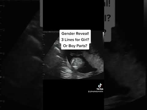 Gender Reveal Ultrasound at 15 Weeks 3 Days Pregnant