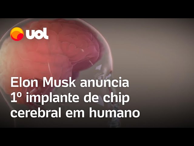Elon Musk Anuncia 1º Implante De Chip Cerebral Da Neuralink Em Humano