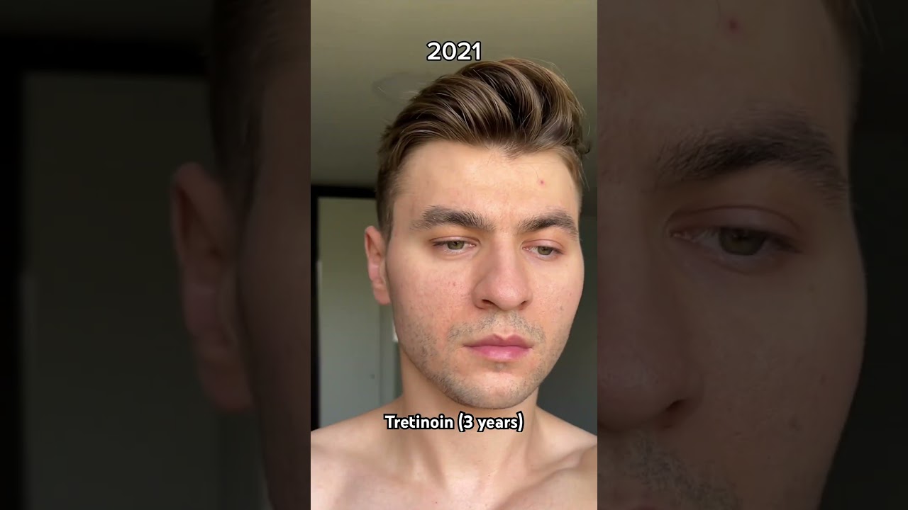 Tretinoin 3 years | before and after